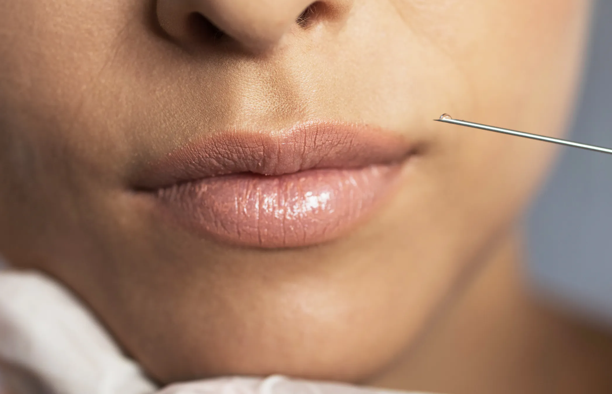 The Pros & Cons Of Lip Botox: What You Need To Know