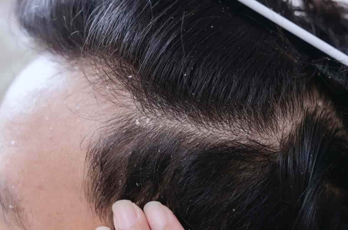 What You Need to Know About Dry Scalp Treatment NZ